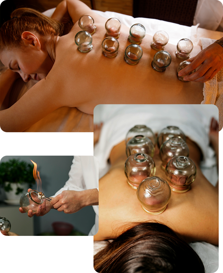 Dry cupping – Madina Healing